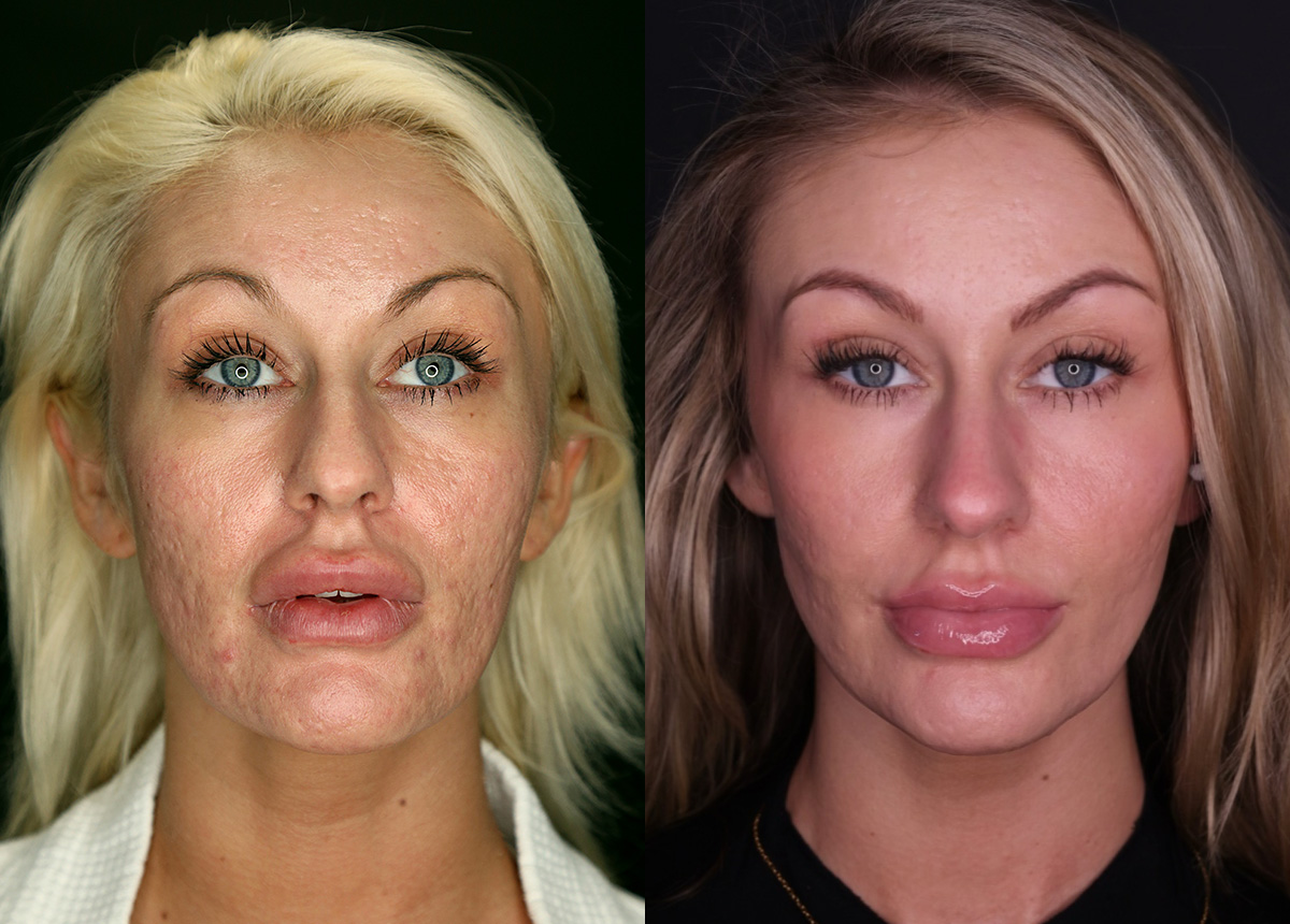 Acne Scar Treatment Before And After Kaado MD Aesthetics Anti Aging Acne Scar Treatment Before And After Kaado MD Aesthetics Anti Aging